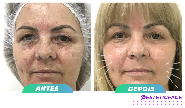 De bem com você - Promo de Peelings Estetic Face!